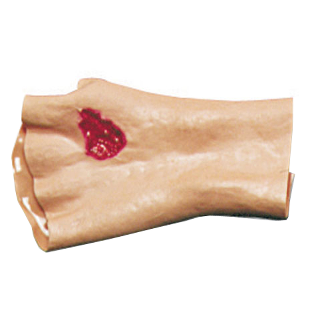 Simulaids Phosphorus Burn of Hand 6001 Non-Bleeding Moulage