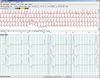 NorthEast Monitoring Holter LX® Analysis Software | Beck-Lee