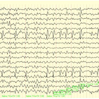 PA18-345C/H Nihon Kohden 18-Channel EEG Paper | Beck-Lee