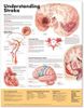 "UNDERSTANDING STROKE" LAMINATED ANATOMICAL CHART 9781587799884