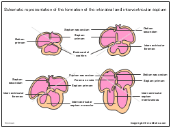 Interventricular Septum Model
