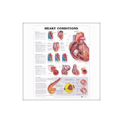 Anatomical Chart Heart Conditions - Chart, Heart Conditions Laminated ...