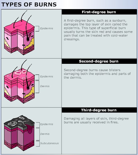 Types of Burns, affecting the epidermis, dermis and subcutaneous skin ...